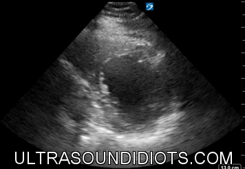 Ultrasound Idiots — Regional Wall Motion Abnormalities