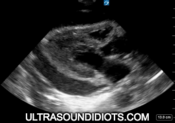 Ultrasound Idiots — Pericardial Effusion and Cardiac Tamponade