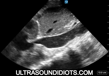 Ultrasound Idiots — Pericardial Effusion and Cardiac Tamponade