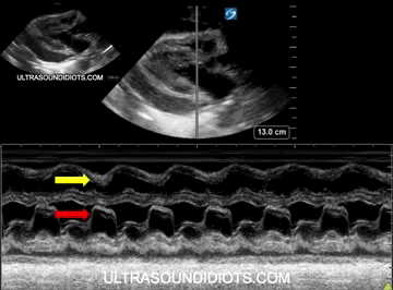 Ultrasound Idiots — Pericardial Effusion and Cardiac Tamponade