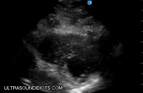 Ultrasound Idiots — limited echo, limited echocardiography, point of ...