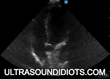 Ultrasound Idiots — limited echo, limited echocardiography, point of ...