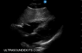 Ultrasound Idiots — limited echo, limited echocardiography, point of ...