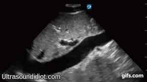 Ultrasound Idiots — Pericardial Effusion and Cardiac Tamponade