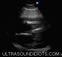 Ultrasound Idiots — Pericardial Effusion and Cardiac Tamponade