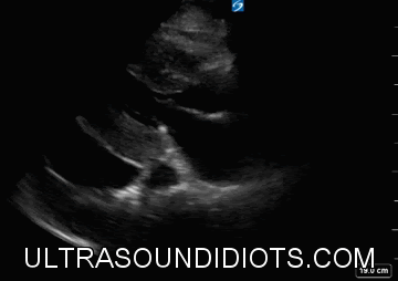Cardiac Tamponade Ultrasound