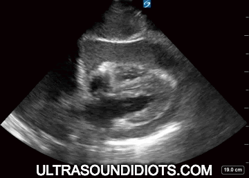 Ultrasound Idiots — Pericardial Effusion and Cardiac Tamponade