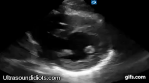 Ultrasound Idiots — Pericardial Effusion and Cardiac Tamponade