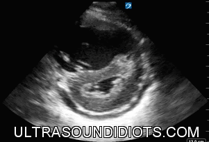 Ultrasound Idiots — Pericardial Effusion and Cardiac Tamponade