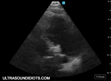 Ultrasound Idiots — POCUS, limited Echo, TTE, Parasternal Long Axis ...