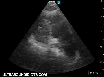Ultrasound Idiots — POCUS, limited Echo, TTE, Parasternal Long Axis ...