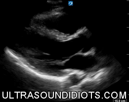 Ultrasound Idiots — TTE - PLAX ARCHIVE