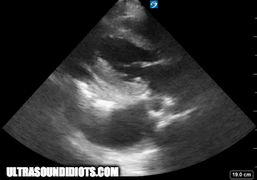 Ultrasound Idiots — TTE - PLAX ARCHIVE