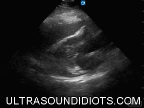 Ultrasound Idiots — TTE - PLAX ARCHIVE