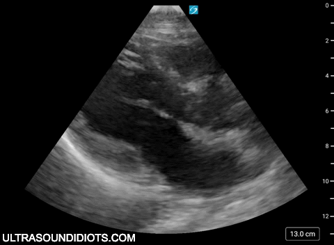 Ultrasound Idiots — TTE - PLAX ARCHIVE