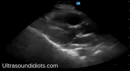 Ultrasound Idiots — TTE - PLAX ARCHIVE