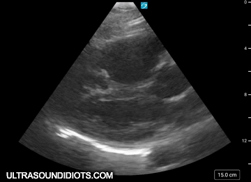 Ultrasound Idiots — TTE - PLAX ARCHIVE