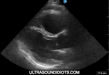 Ultrasound Idiots — TTE - PLAX ARCHIVE