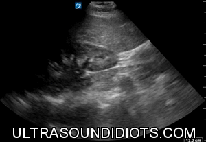 Ultrasound Idiots — Trauma / EFAST