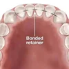 Retainers — Hugo Orthodontics