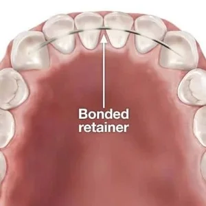 Retainers — Hugo Orthodontics