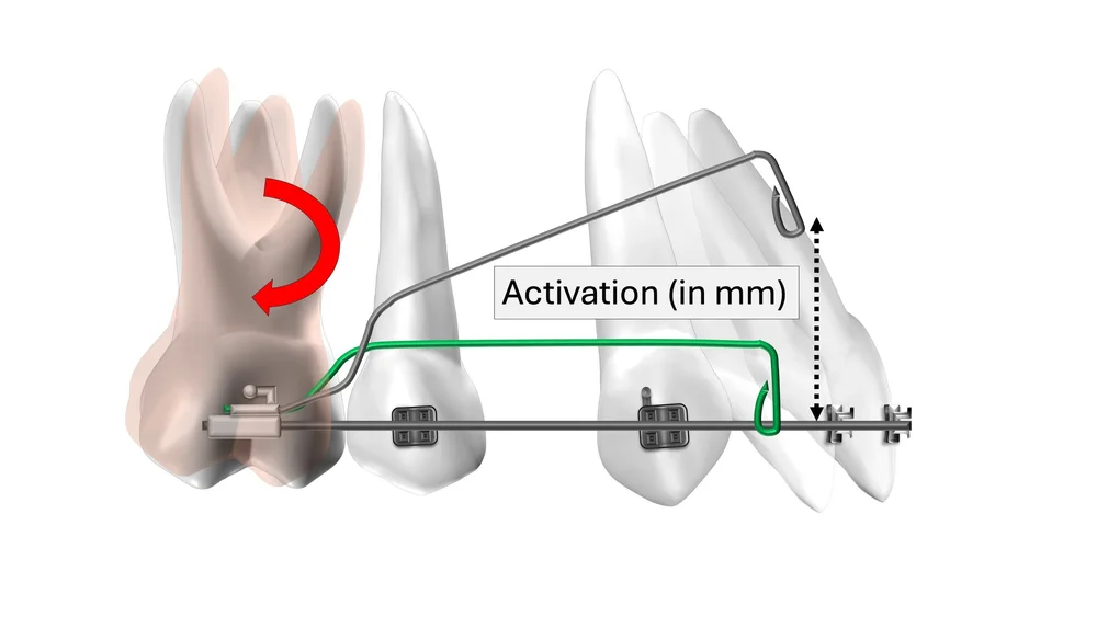 Cantilever Spring (Anchorage) — Orthobites