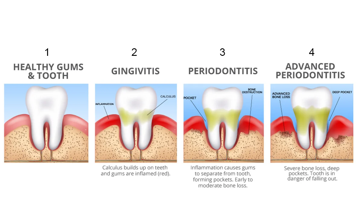 What To Do When You Have Gingivitis — EMERGENCY DENTIST SYDNEY