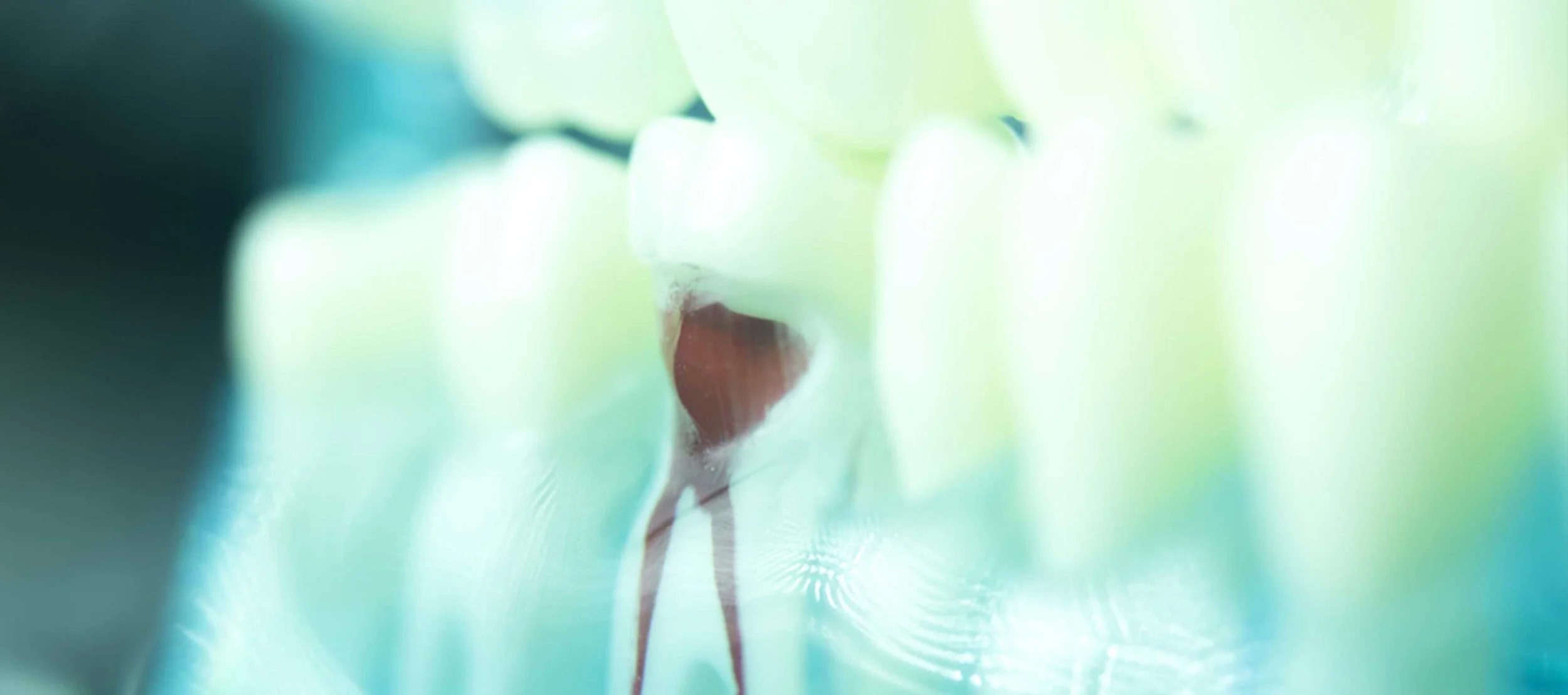 What is a Pulp Extirpation? — Emergency Dentist Sydney
