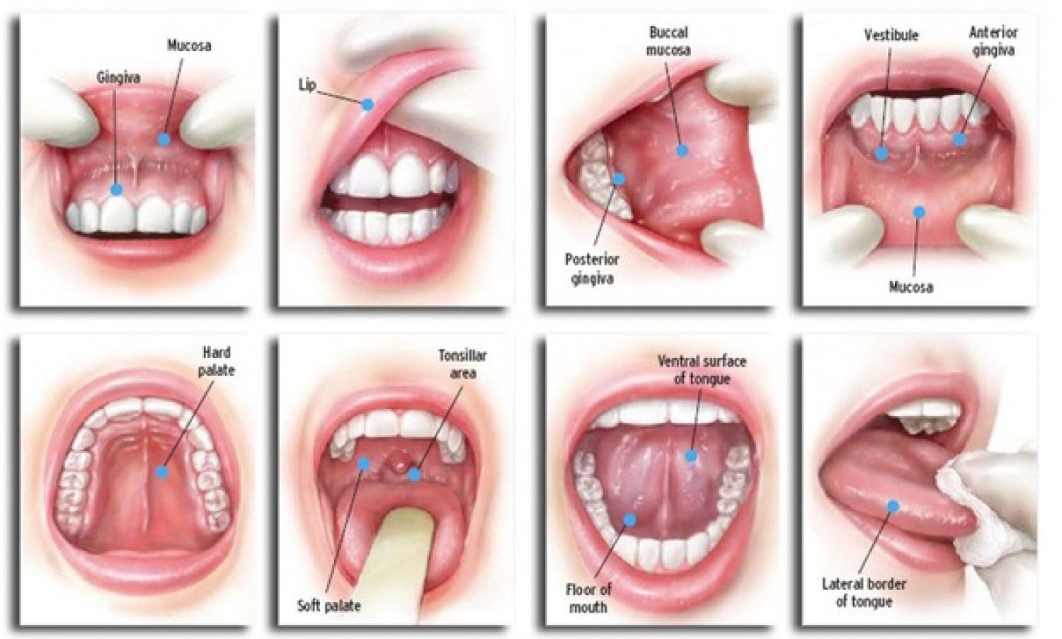 Signs Of Oral Cancer — Emergency Dentist Sydney