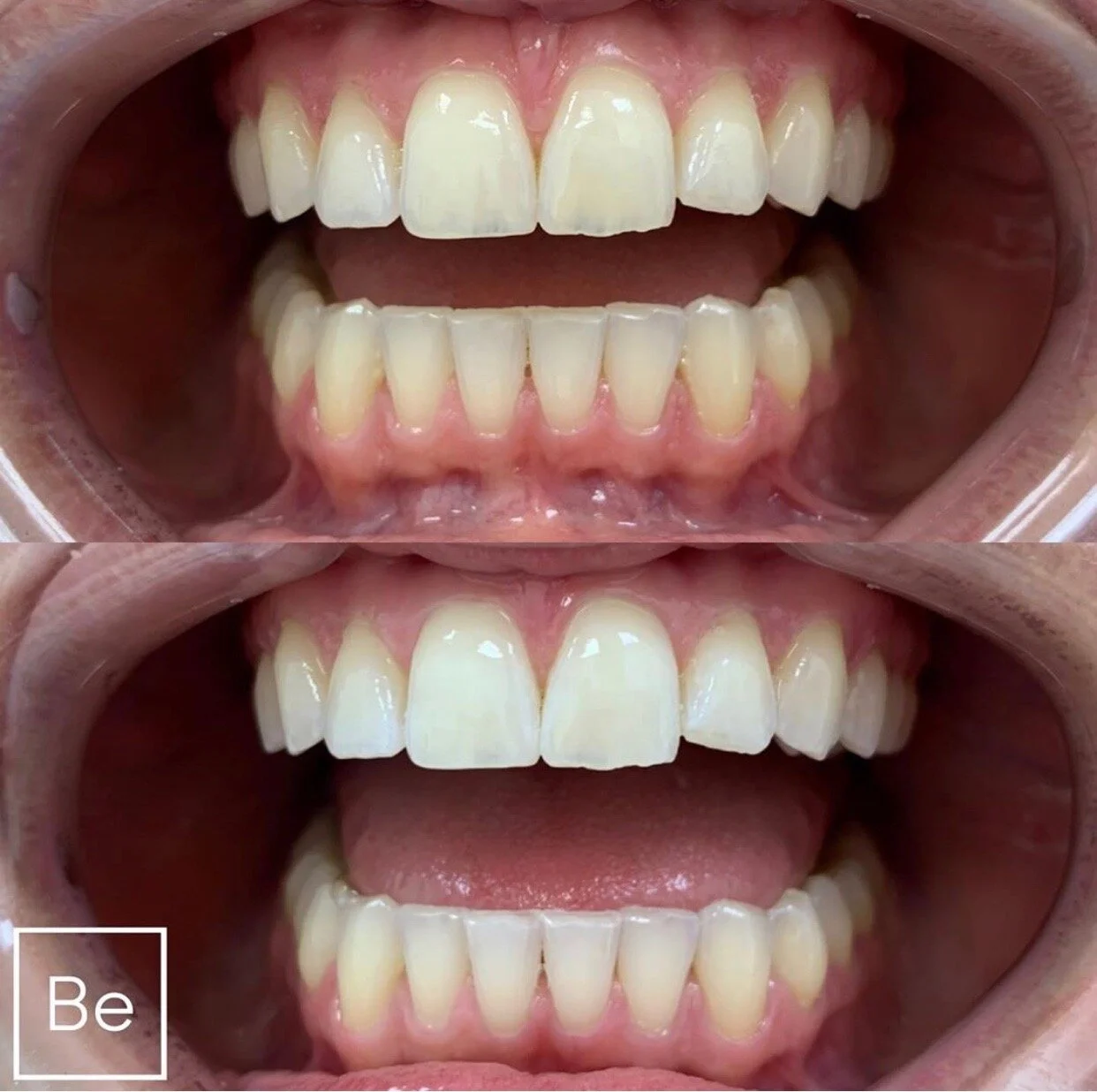 FDA-Approved Teeth Whitening Solutions Rochester NY