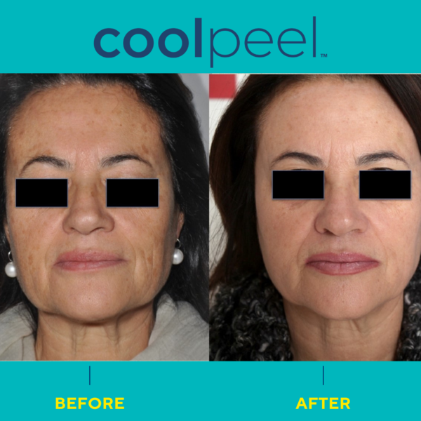 CoolPeel Laser Resurfacing in Rochester, NY | Bare Element