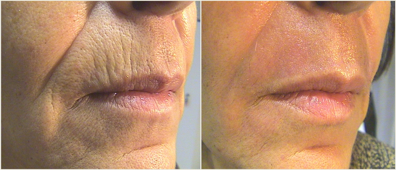CoolPeel Laser Resurfacing in Rochester, NY | Bare Element CoolPeel Laser Resurfacing in Rochester, NY | Bare Element