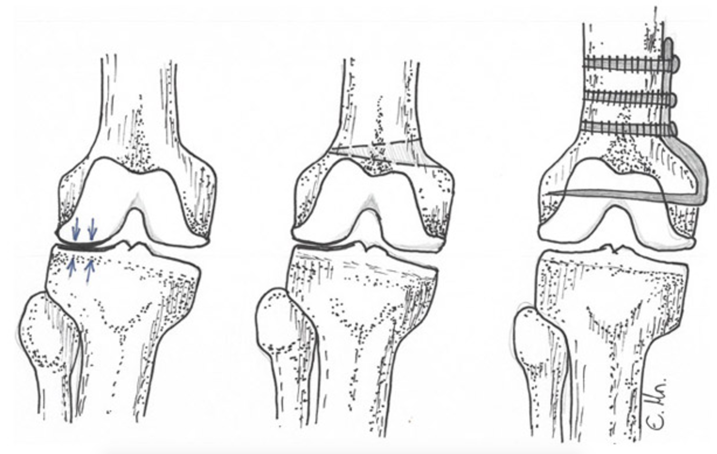 Osteotomy Amir Qureshi Orthopaedic Surgeon Knee Surgeon Southampton