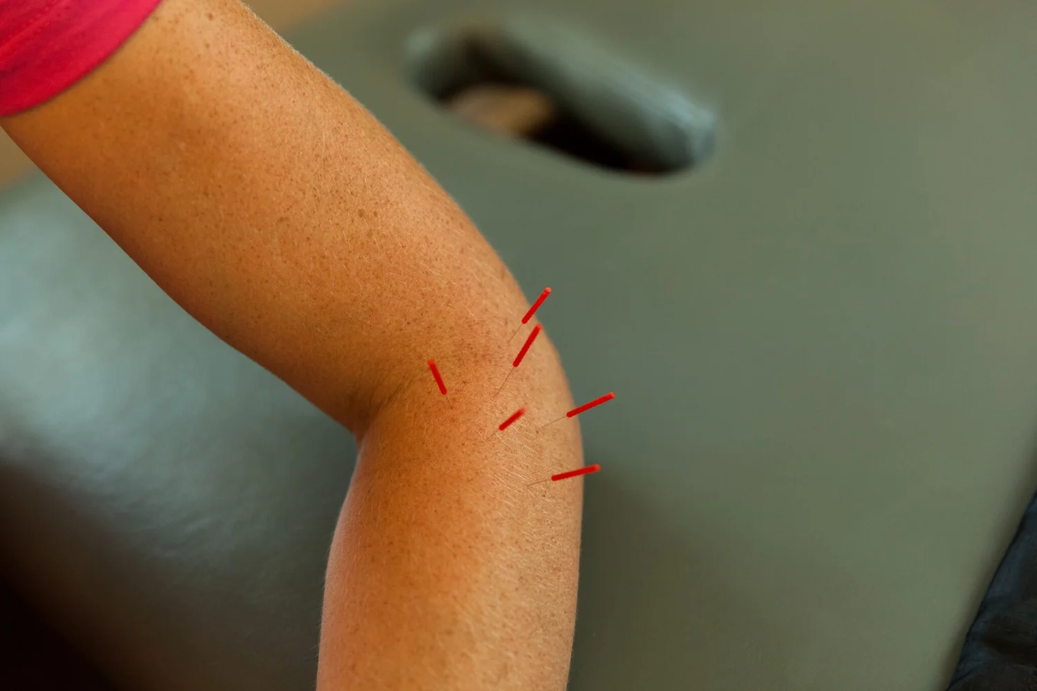 Dry Needling | In Motion