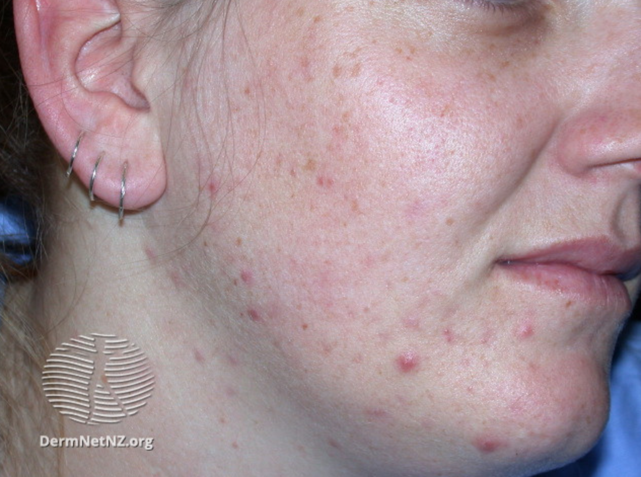 Hormonal Acne: Why It Happens And How To Treat It — AEGEAN | MD