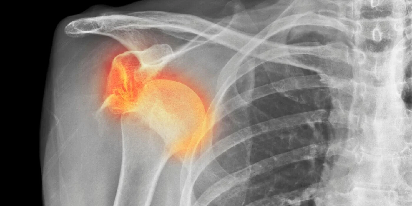 Shoulder Pain - Diagnosis, Causes, Treatments, Solutions