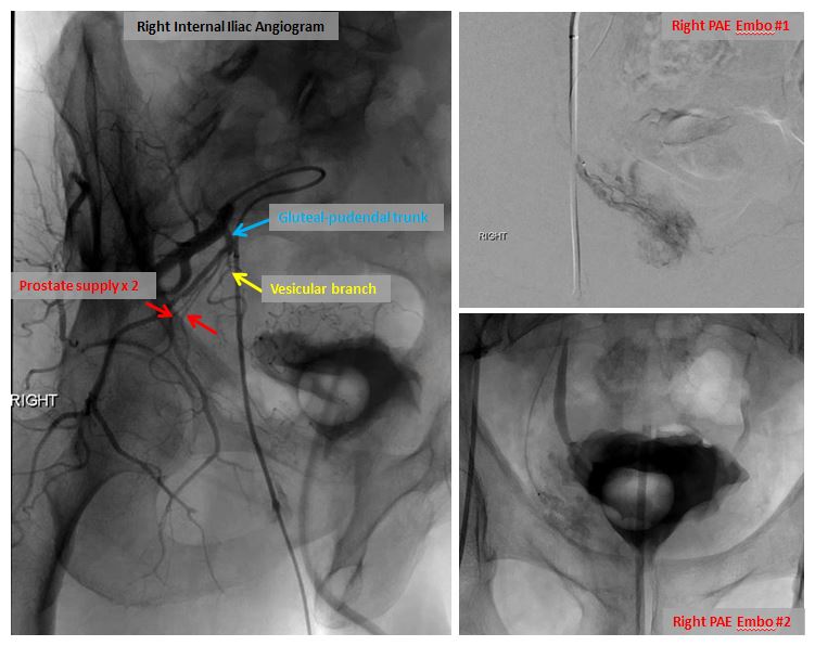 PROSTATE ARTERY EMBOLIZATION — Albany IR PROSTATE ARTERY EMBOLIZATION — Albany IR