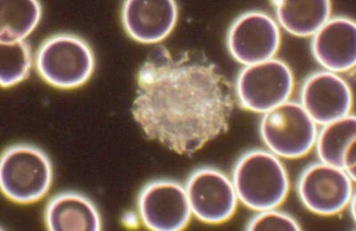 Case Notes from the Live Blood Analysis Clinic: Leukaemia under the ...