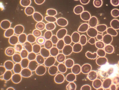 Case Notes from the Live Blood Analysis Clinic: Leukaemia under the ...