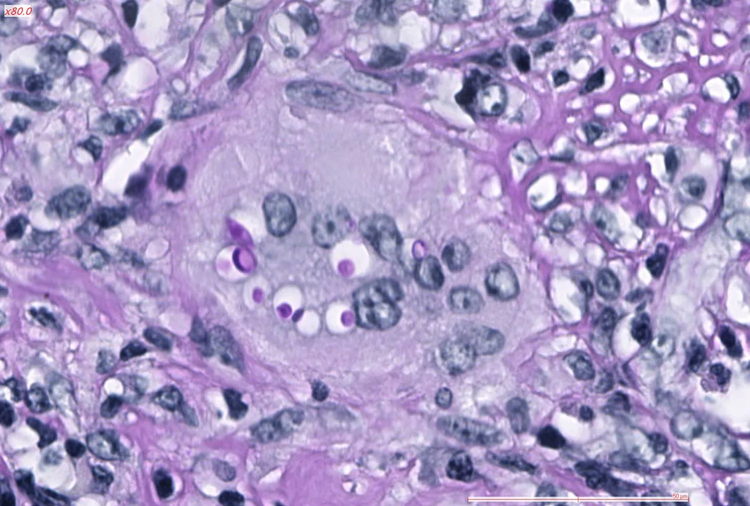 Cryptococcus Histology