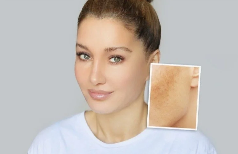 How UV Exposure Causes Skin Dark Spots and Hyperpigmentation?