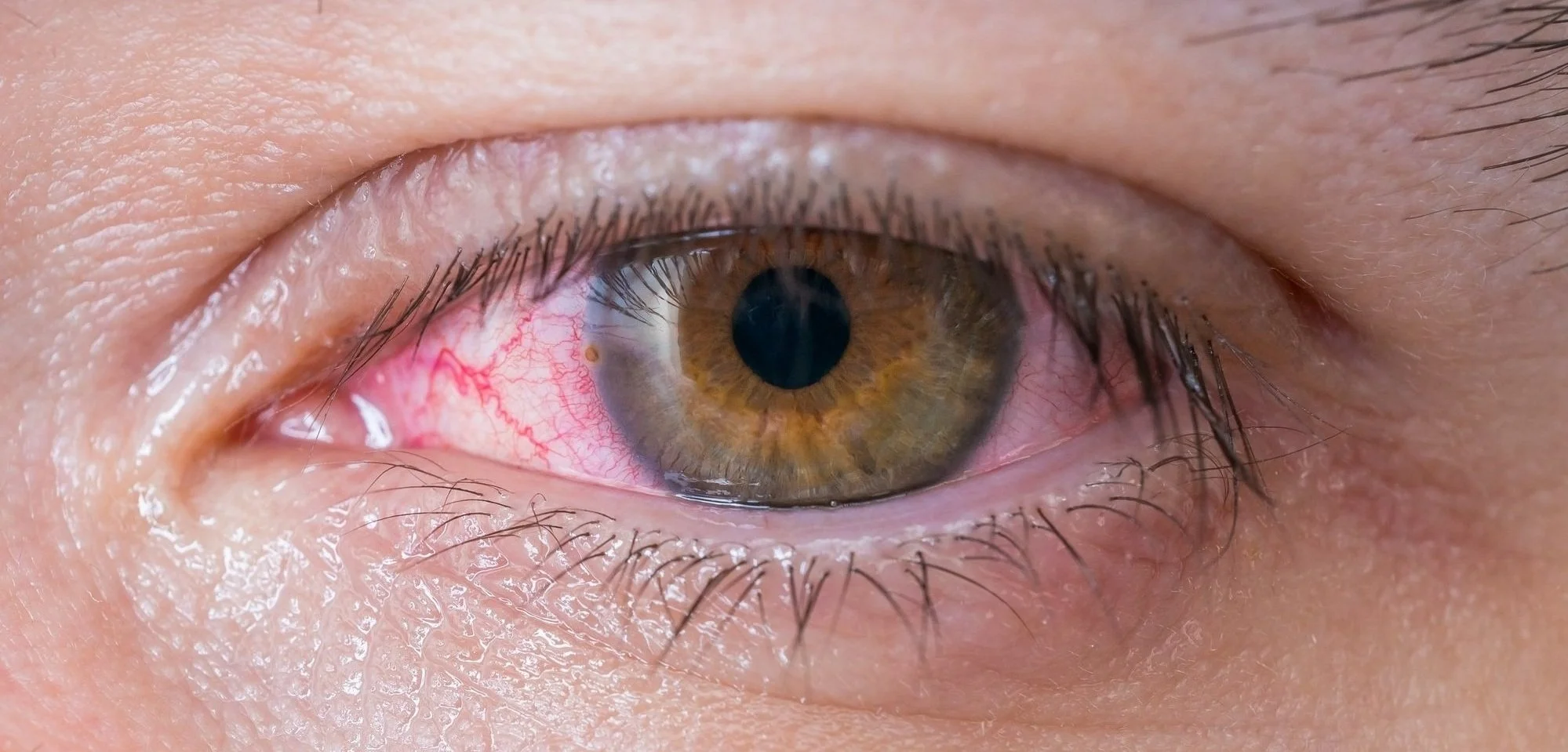 Symptoms Of Red Eye And How To Prevent Them Eye Concepts