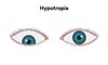Understanding Strabismus: Symptoms, Causes, and Treatment Options