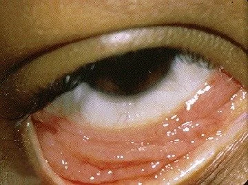 Eye Infection: Top Symptoms and Effective Treatment Options