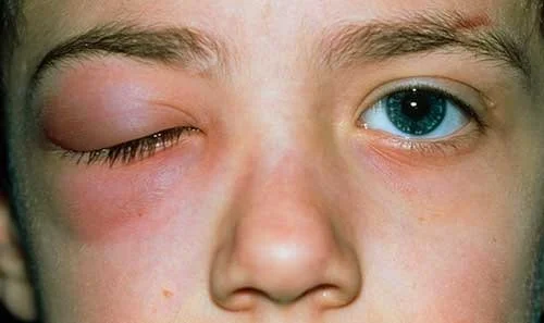 Eye Infection: Top Symptoms and Effective Treatment Options