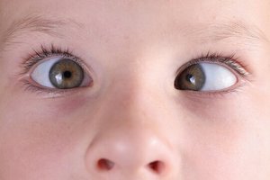 Understanding Strabismus: Symptoms, Causes, and Treatment Options
