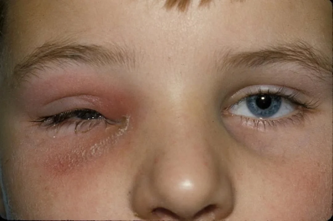Eye Infection: Top Symptoms and Effective Treatment Options