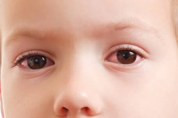 Understanding Red Eye in Kids: Causes and Care Tips