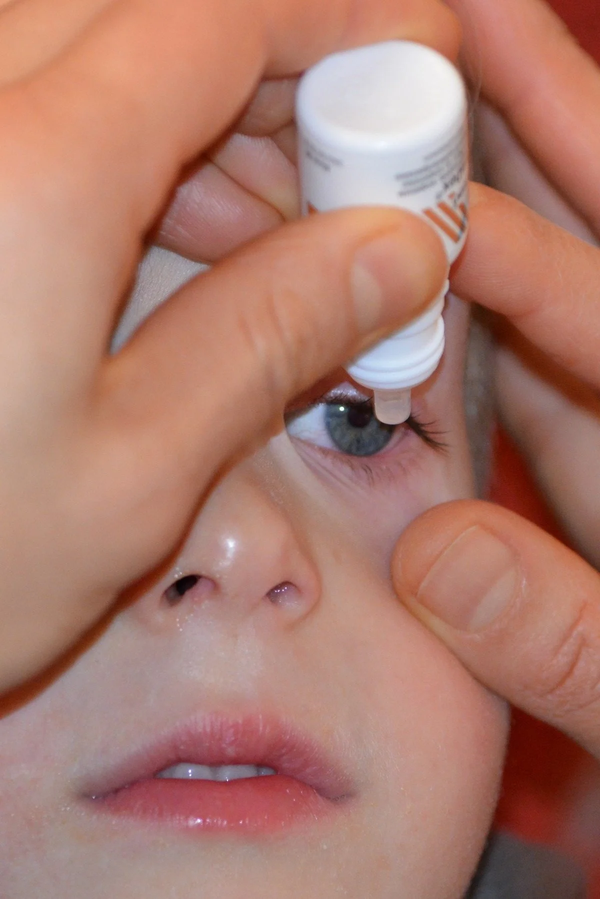 Understanding Red Eye in Kids: Causes and Care Tips