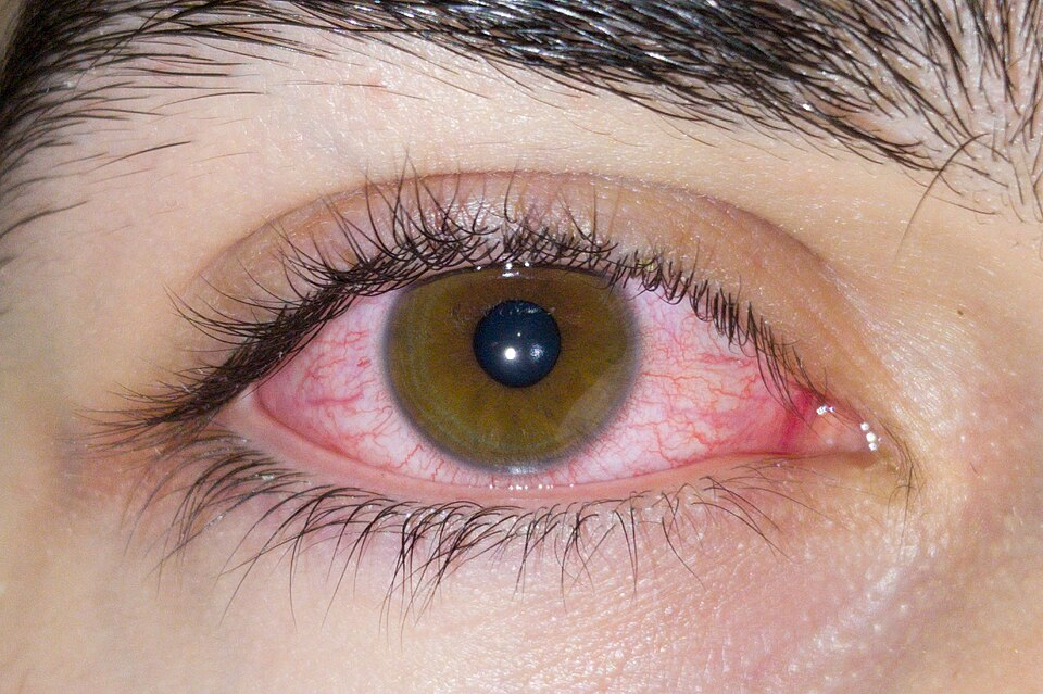Eye Allergy: Causes, Symptoms, Treatments, and Prevention